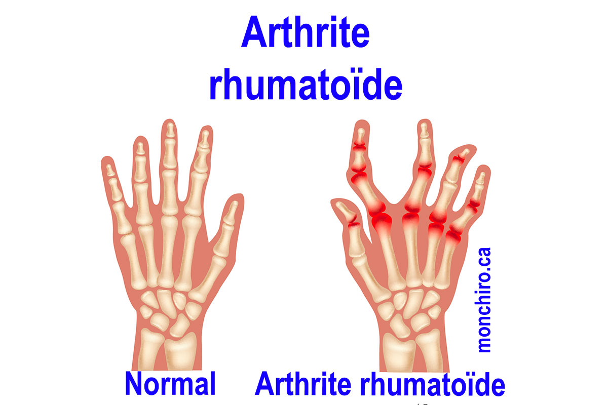 Arthrose, Arthrite, Polyarthrite, Spondylarthrite, Quézako ...